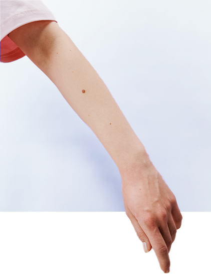Benign Moles Removal - Palm Beach Dermatology Group