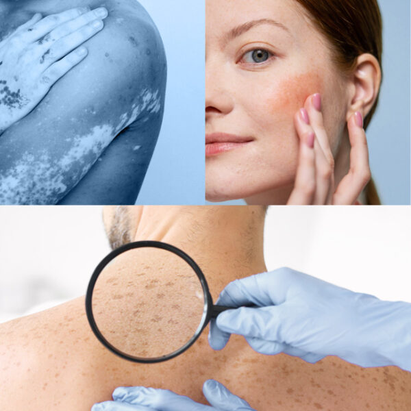 Pigment Disorders - Palm Beach Dermatology Group