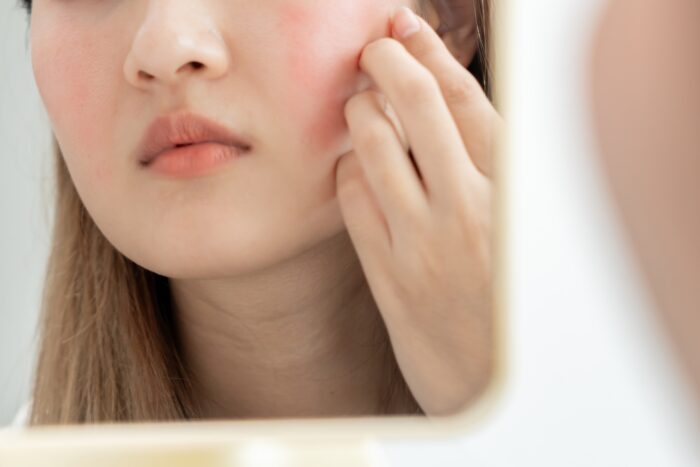 Why Is My Face Always Red? 7 Common Causes and Solutions