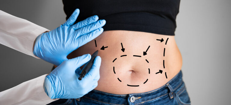 Managing Liposuction Scars: Prevention and Treatment Tips