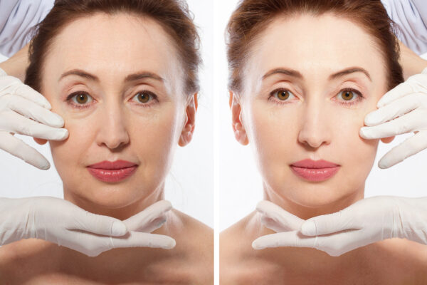 What Is A Mini Facelift? Procedure, Risks, Benefits & Cost