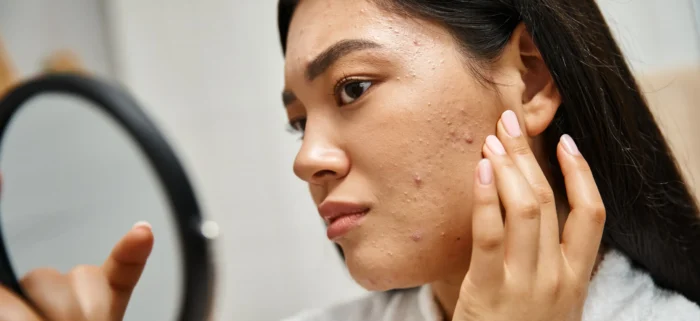 Cystic Acne: Main Causes, Hormonal Triggers & Prevention